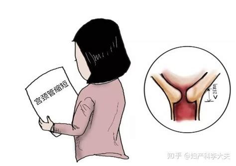 宫颈变短，就一定会早产吗？ 知乎