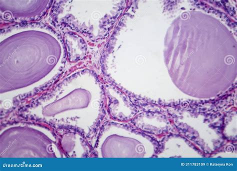 Benign Prostatic Hyperplasia Light Micrograph Stock Image Image Of Anatomy Proliferation
