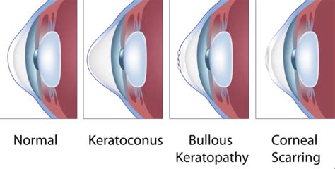 Cornea Anatomy And Functions