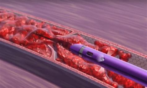 Angiojet™ Peripheral Thrombectomy System Arterial Boston Scientific