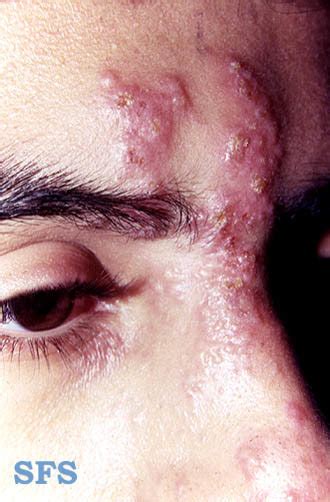 Shingles Herpes Zoster Ehealthstar