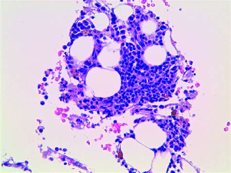 Histological Examination Of First Bone Marrow Aspiration Showing Pure