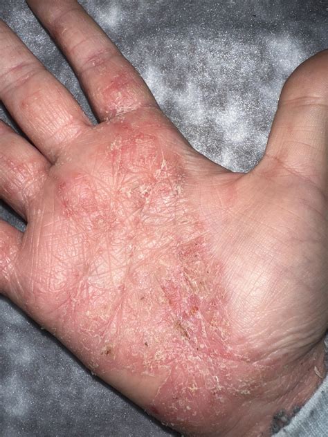 Advice For Products R Dyshidrosis