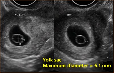 Yolk Sac 6 Weeks