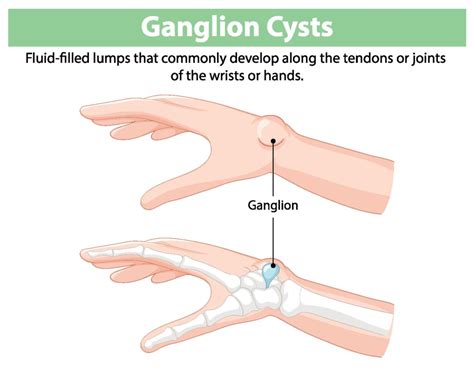 Ganglion Cyst Removal