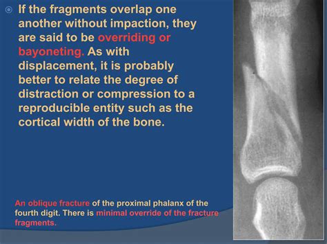 Bone Trauma Common Fractures Long Boneppt