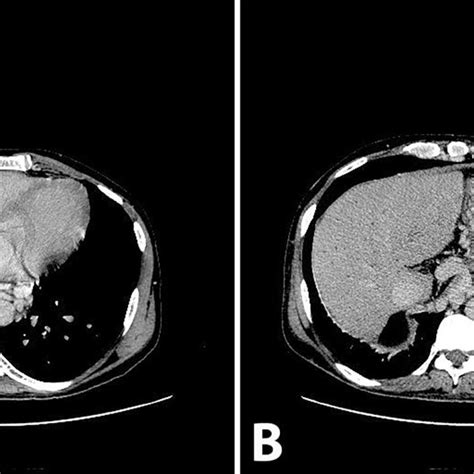 A Y O Male Patient Presented With Upper Gastrointestinal GI Download Scientific Diagram