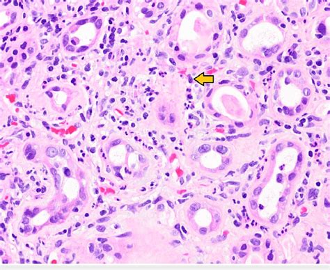 Neutrophilic Interstitial Inflammation The Arrow Shown Indicates