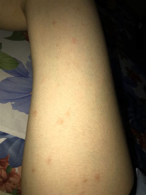 Bị ngứa ạ HelloBacsi