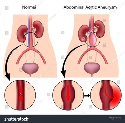 Abdominal Aortic Aneurysm Over 391 Royalty Free Licensable Stock Illustrations And Drawings