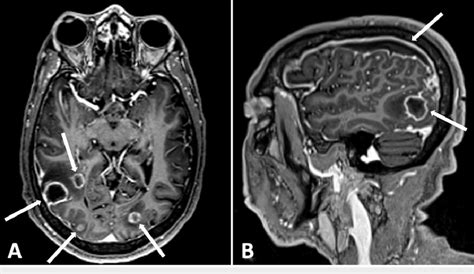Initial Brain Mri Demonstrating Multifocal Ring Enhancing Lesions In Download Scientific