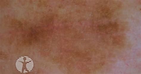 Solar Lentigo Image