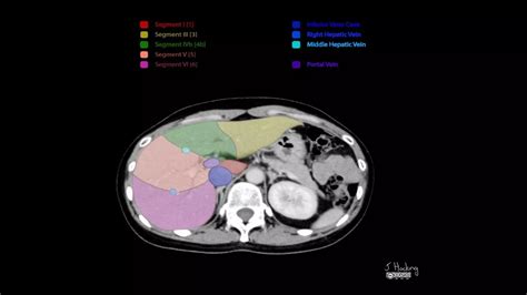 Liver Ct Anatomy1pptx