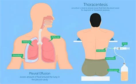 Procedure Of Ptca Surgery Explained Medisuggest