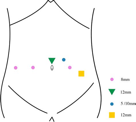 Robot Assisted Supratrigonal Cystectomy And Augmentation Cystoplasty