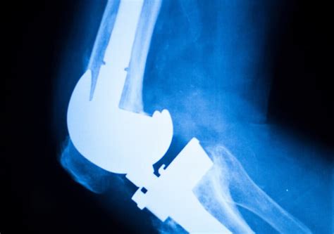 Knee Joint Implant Testing Applus Laboratories