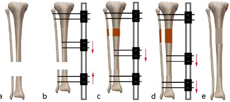 Figure 2 From Reconstruction Of Long Segmental Tibial Bone Defect Using
