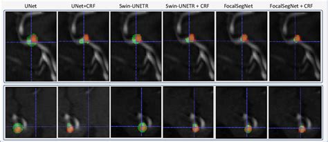 Figure 2 From Weakly Supervised Segmentation Of Intracranial Aneurysms Using A 3d Focal