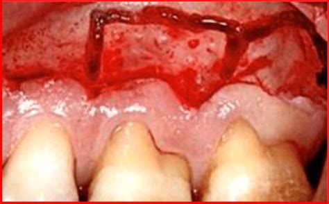 Corticotomy To Intrusion Of Maxillary Molars Source Oliveira D D Download Scientific