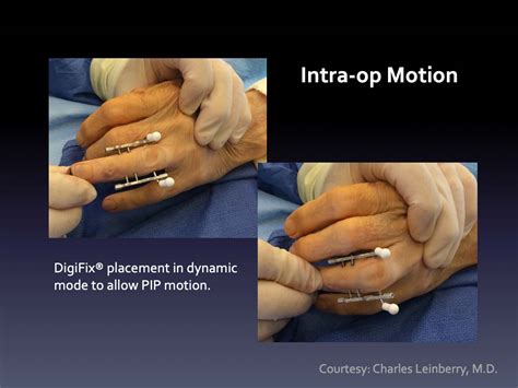 Case 2 Pip Fx Dislocation Virak Orthopedics