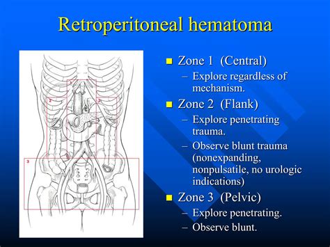 Retroperitoneal Hematoma Types And Management The Lect Ppt