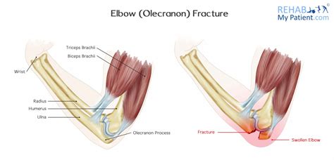 Elbow Olecranon Fracture Rehab My Patient