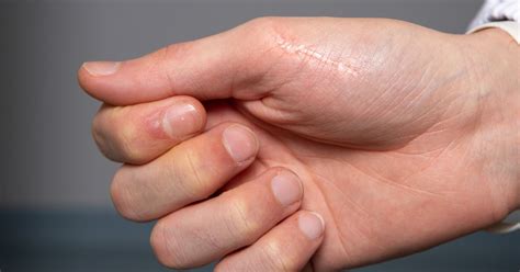 Types Of Scar Tissue And How To Prevent Them Facty Health