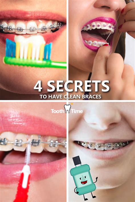 Tightening Self Ligating Braces Comfortable And Effective Artofit