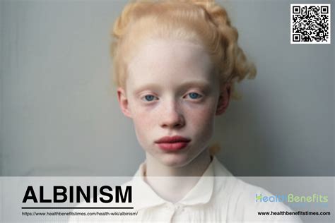 Albinism Health Benefits