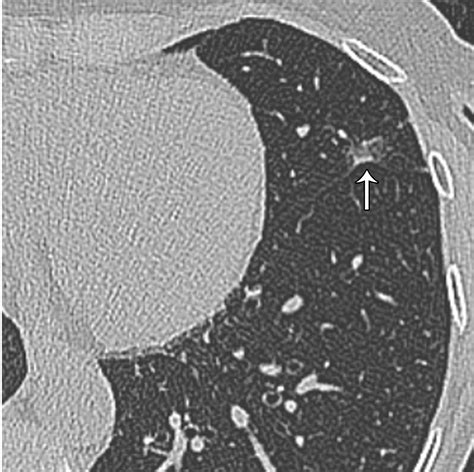 Updated Fleischner Society Guidelines For Managing Incidental Pulmonary