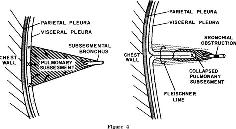 Figure 4 From Fleischner Lines And Pulmonary Emboli Semantic Scholar