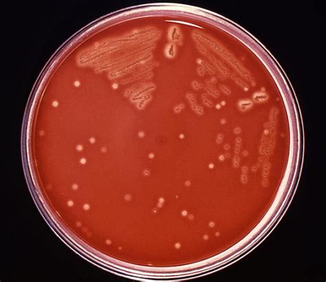 Streptococcus Anginosus Treatment