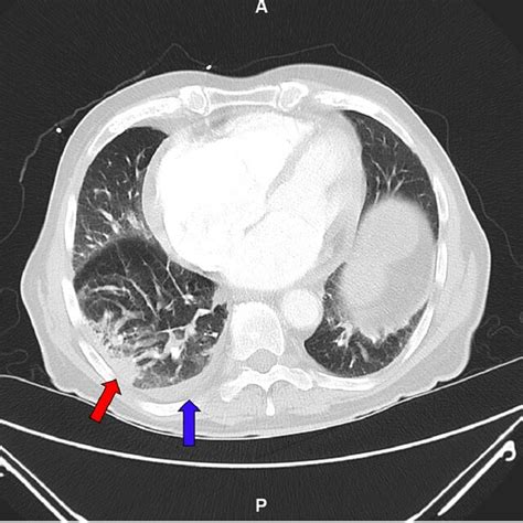 Cta Pulmonary Axial View Showing A Right Sided Lower Lung Lobe Download Scientific Diagram