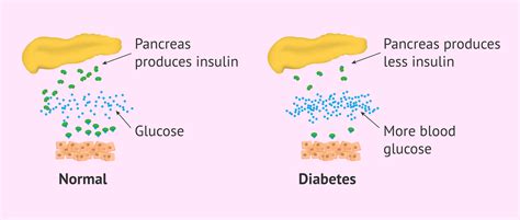 Why Does Diabetes Occur