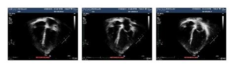 Original Cardiac Ultrasound Images A First Row Dataset Number 1