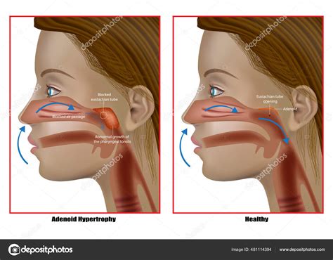 Adenoid Hypertrophy The Abnormal Growth Of The Pharyngeal Tonsils