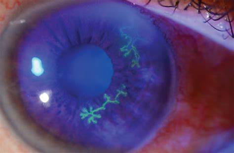 Photos For Herpes Simplex Keratitis Hsk Dendritic Corneal Ulcer