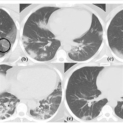 Non Contrast Ct Chest Axial Cuts In Lung Window Showing The Main Download Scientific Diagram
