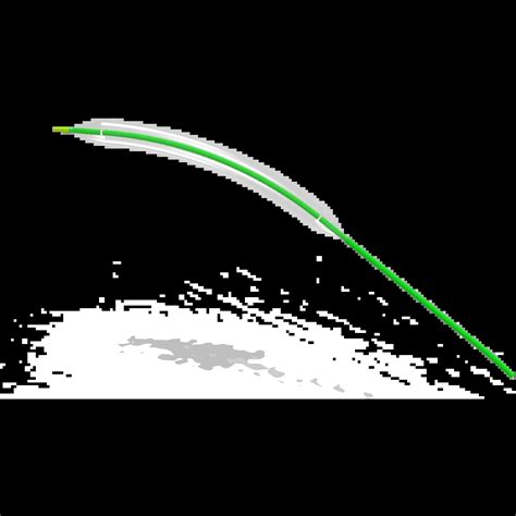 Application Of Ptca Balloon In Coronary Angioplasty