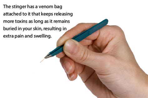 How To Treat A Bee Or Wasp Sting Emedihealth