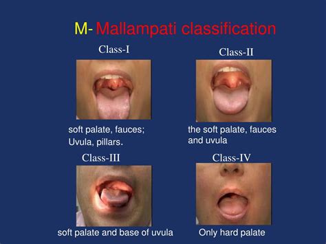 Ppt Difficult Airway Management Powerpoint Presentation Free Download Id5562543