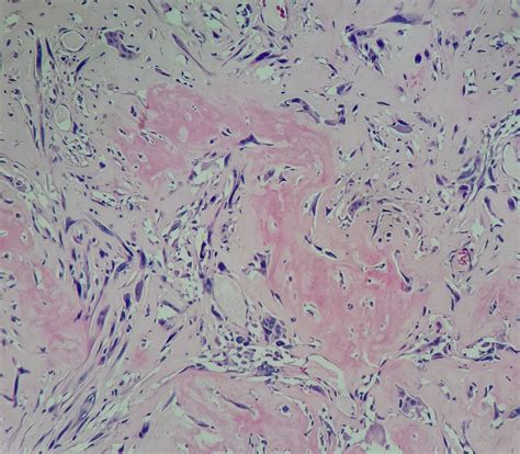 Cld 201 Receives Fda Fast Track Designation Targeting Sarcoma