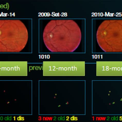 Pdf Microaneurysm Turnover In The Macula Is A Biomarker For