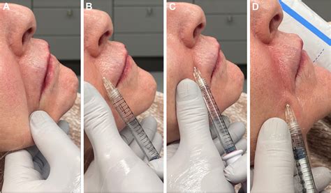 Perioral Filler Augmentation Atlas Of The Oral And Maxillofacial