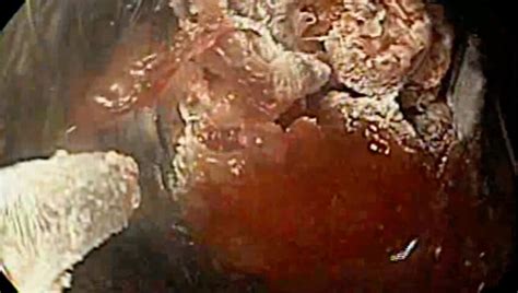 Frosting Effect After Application Of Cryotherapy To The Embedded Tissue Download Scientific