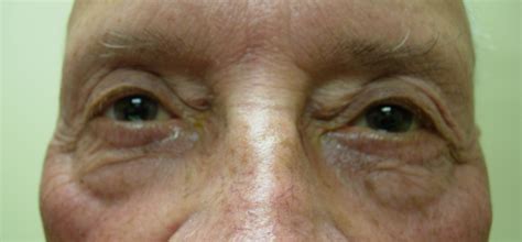 North Houston Eye Care Dermatochalasis Aka Droopy Eyelid In Houston