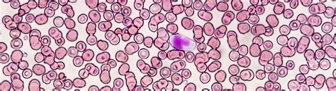 Lupus And Thrombocytopenia Kaleidoscope Fighting Lupus