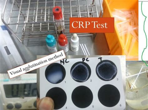 CRP Test Introduction Testing Procedure Normal Range And Clinical
