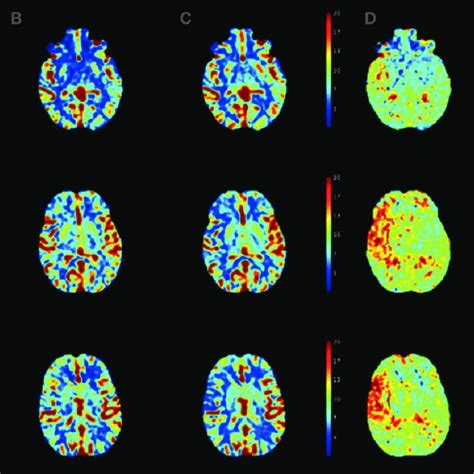 Rapid Perfusion Imaging And Non Contrast Brain Computed Tomography Upon Download Scientific