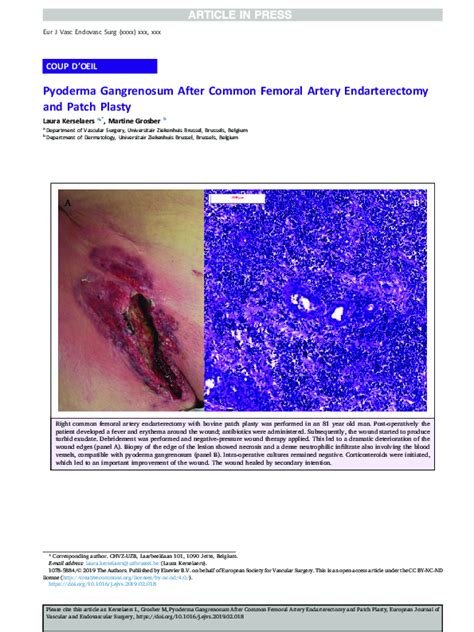 Pdf Pyoderma Gangrenosum After Common Femoral Artery Endarterectomy And Patch Plasty